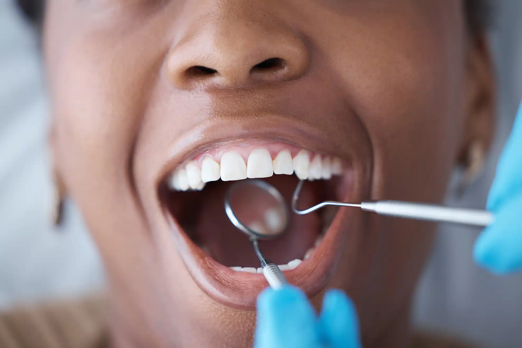 Teeth Cleaning Dentist in Westerville OH - Dental Cleanings